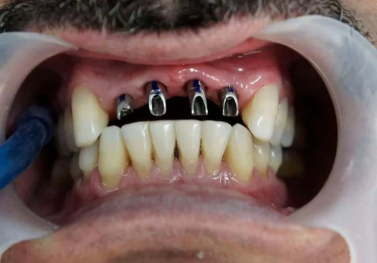 Implante dentário dos 4 dentes da frente: Saiba tudo sobre